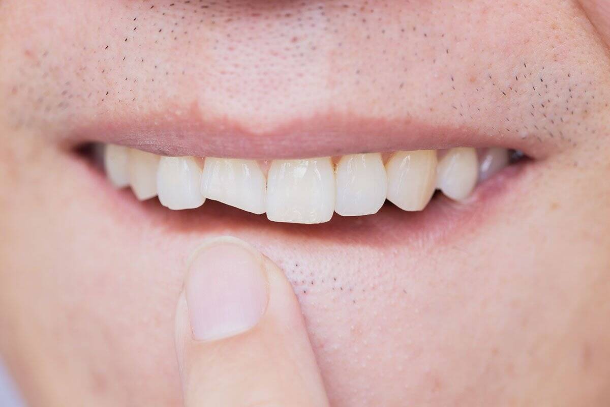 Knocked-Out Tooth Leederville - Dentists on Vincent Leederville