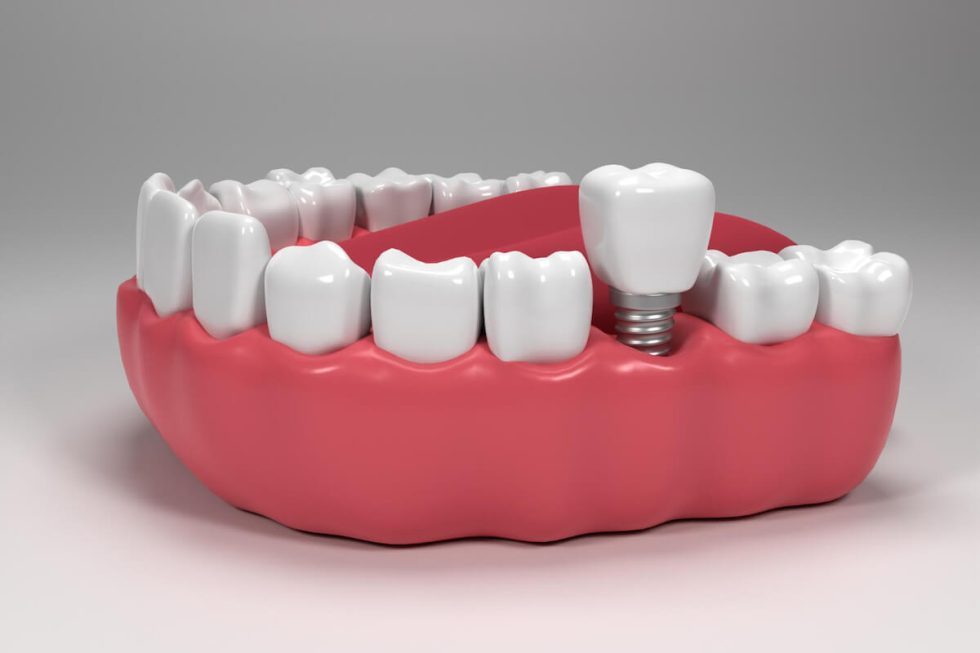 Caring for Your Dental Crown: Tips for Longevity and Maintenance ...